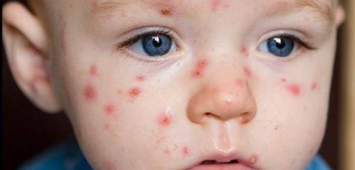 Epidemie de rujeola in Romania. Avem aproape 2000 de cazuri - Opinia ... Epidemie de rujeola in Romania. Avem aproape 2000 de cazuri - Opinia ...